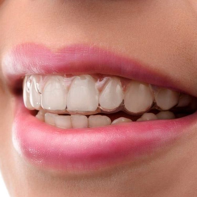 ClearCorrect – OZ Care Dental